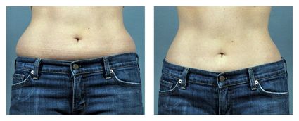 Liposuction with PAL,Dr.Mohsen Fadaei Plastic surgeon