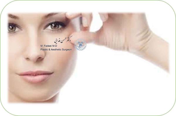 temple lift - Everything About TEMPLE LIFT Surgery - Dr.Mohsen Fadaei