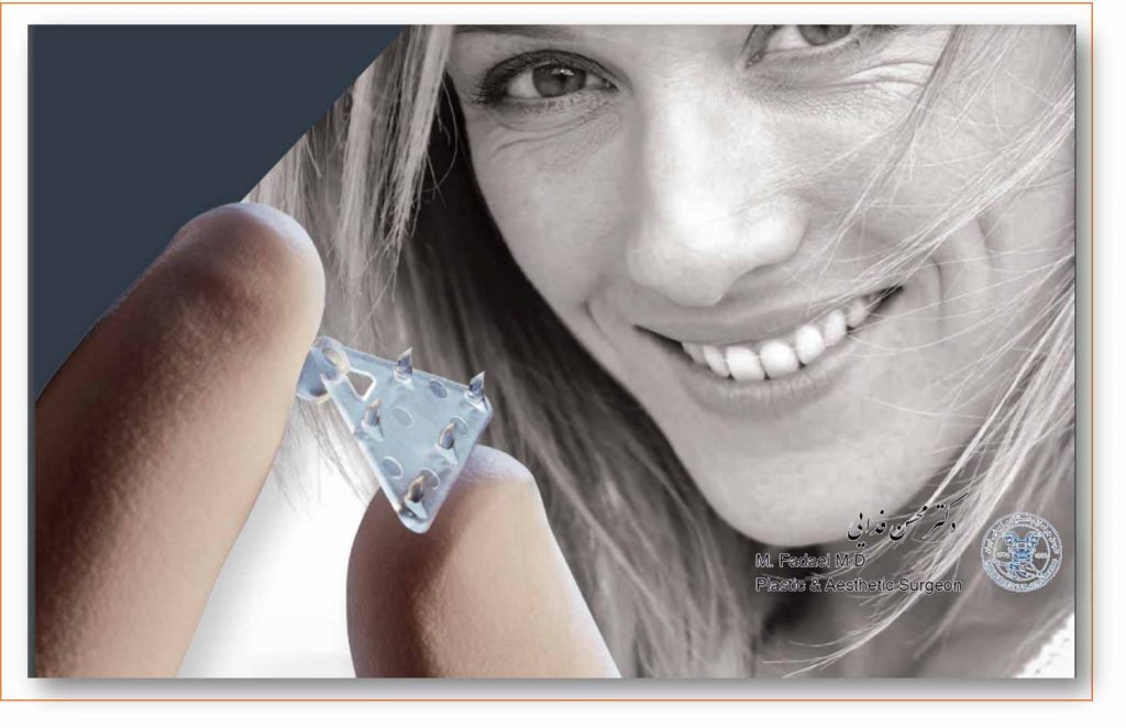 Endotine facelift - face lift surgery with Endotine - Dr.Mohsen Fadaei