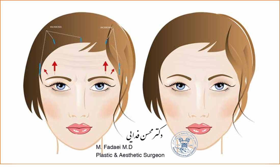 brow lift and forehead lift - Dr.Mohsen Fadaei - brow lift - forehead lift