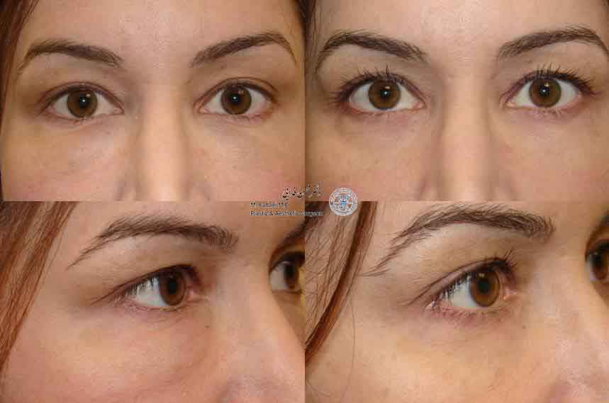 filler removal and filler dissolving , Dr.Mohsen Fadaei