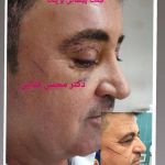 temple lift - Everything About TEMPLE LIFT Surgery - Dr.Mohsen Fadaei